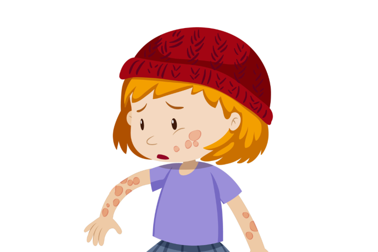 Ringworm in Children - Bootin and Savrick Pediatric Associates